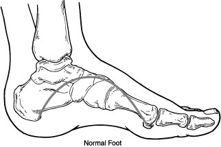 Charcot Foot - Family Podiatry Center